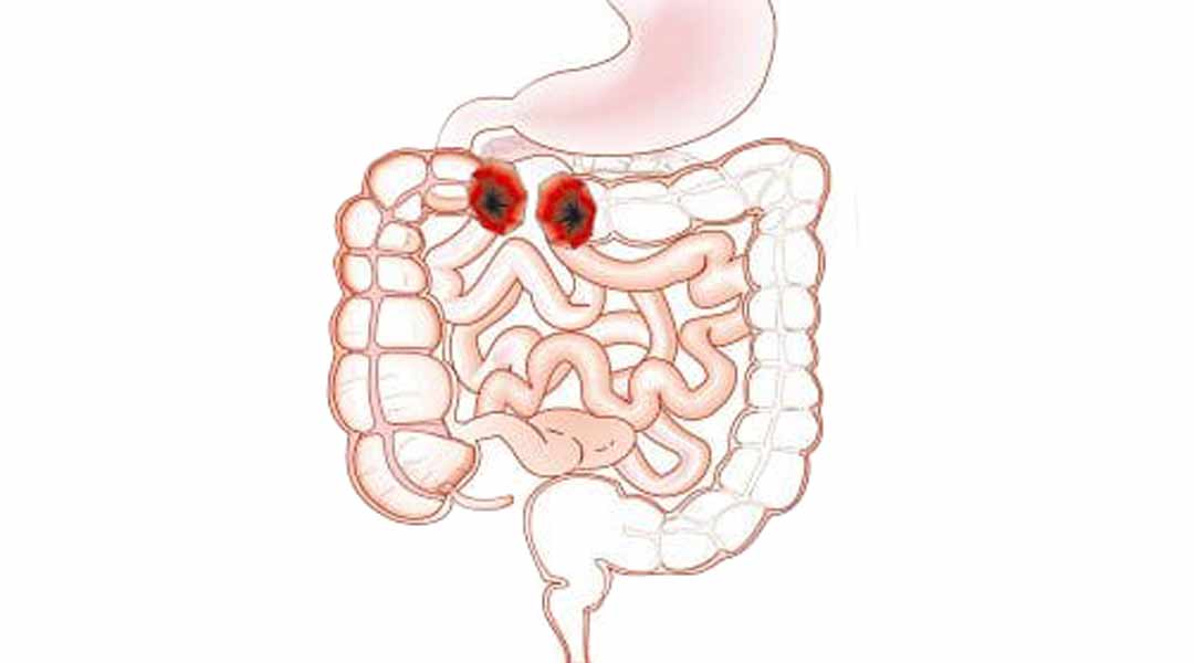 Colostoma - unsere Experten beraten Sie!